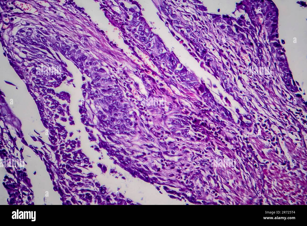 Carcinome cellulaire transitoire de la vessie, micrographe léger, photo ...
