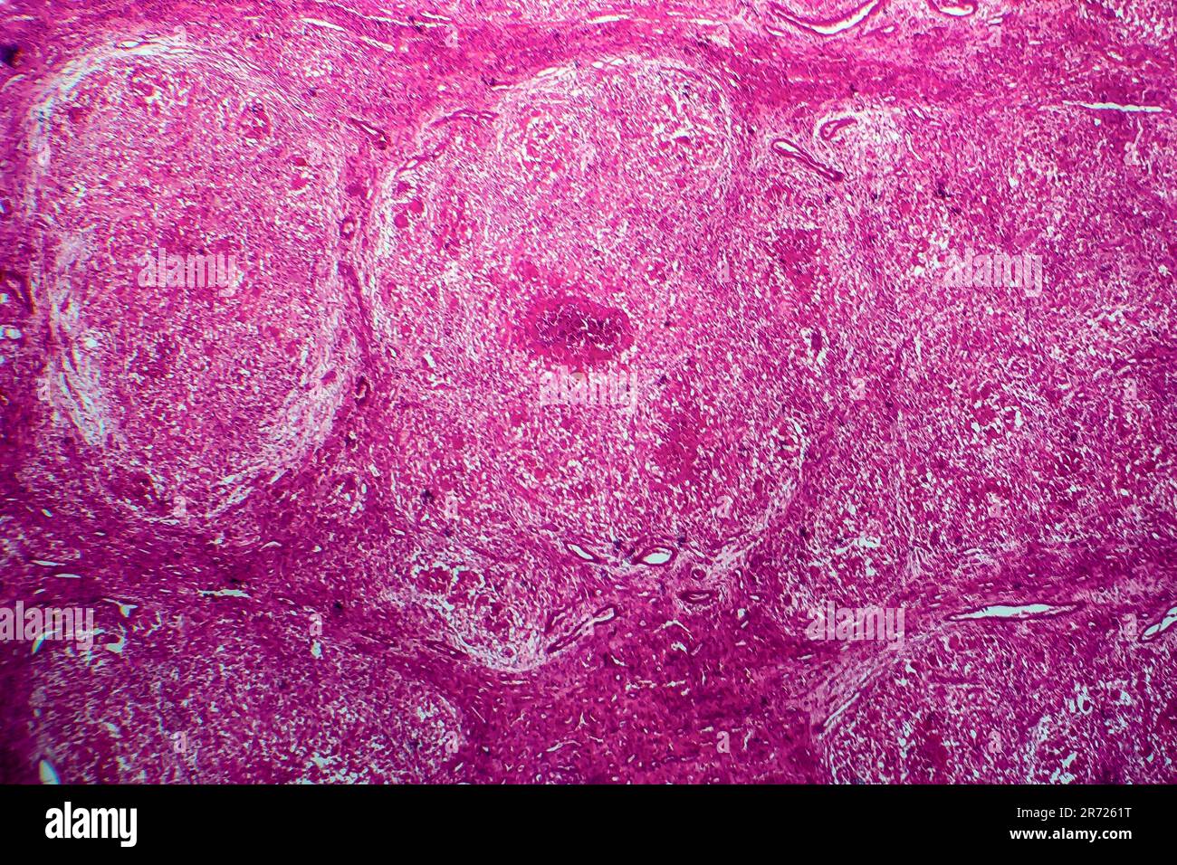 Tuberculose rénale, micrographe léger, photo au microscope Photo Stock ...