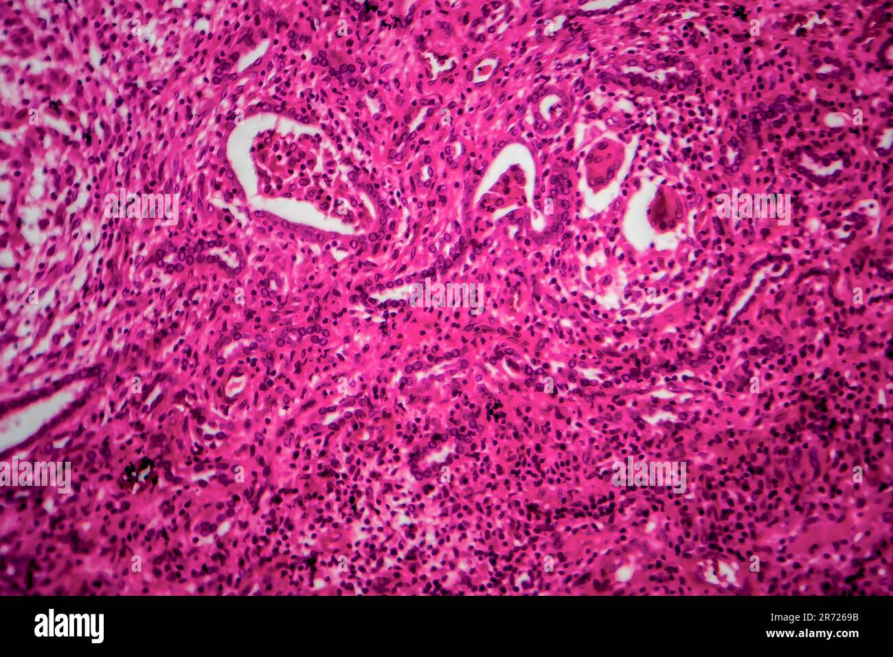 Tuberculose rénale, micrographe léger, photo au microscope Photo Stock ...