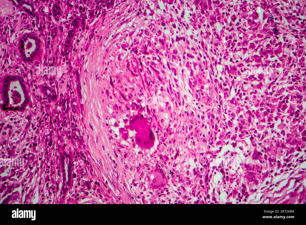 Tuberculose rénale, micrographe léger, photo au microscope Photo Stock ...