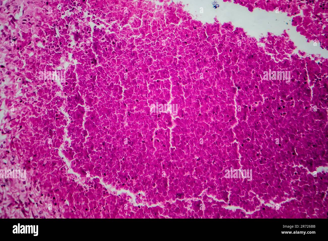 Tuberculose rénale, micrographe léger, photo au microscope Photo Stock ...