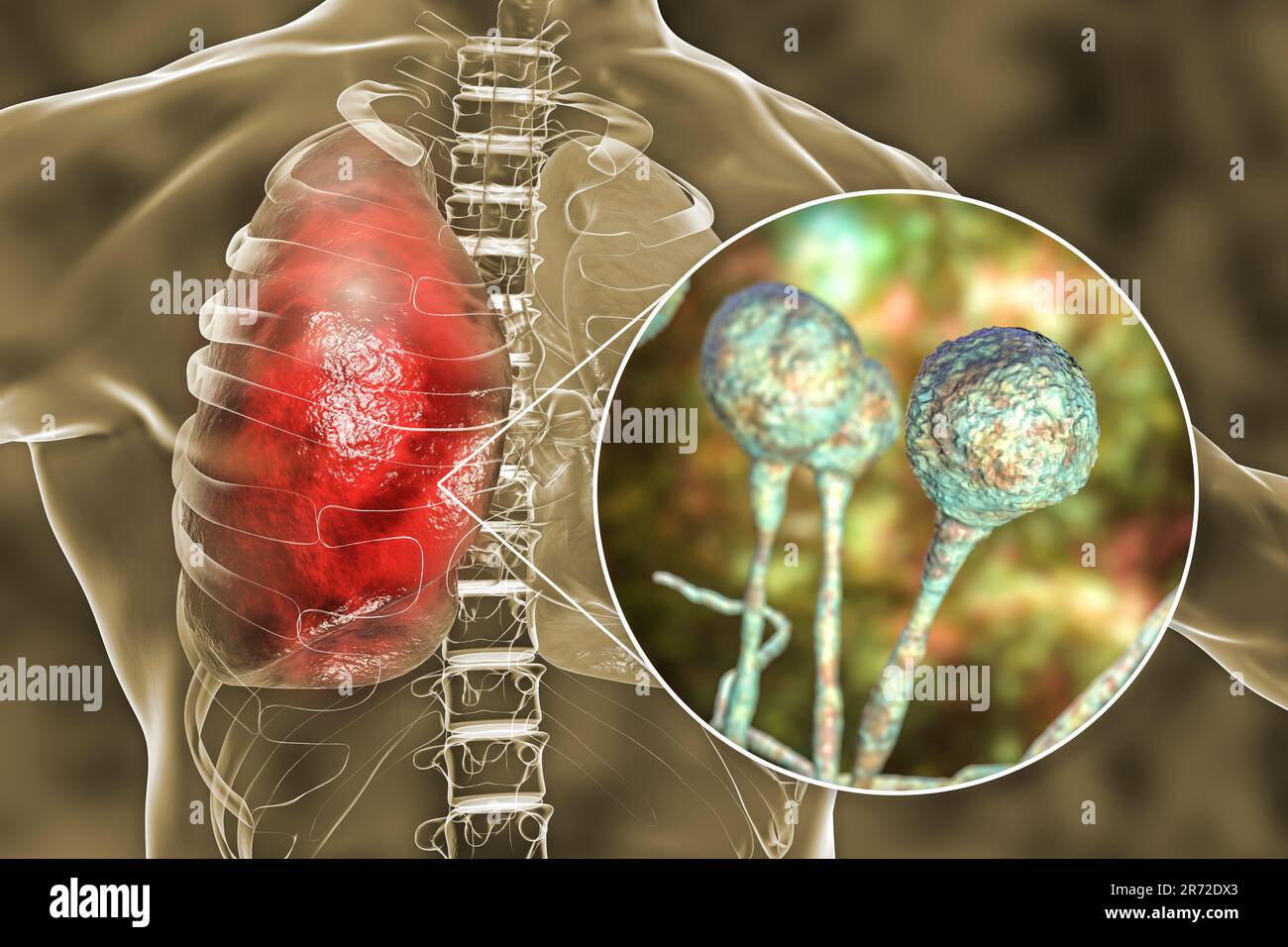 Mucormycose pulmonaire Banque de photographies et d’images à haute résolution - Alamy