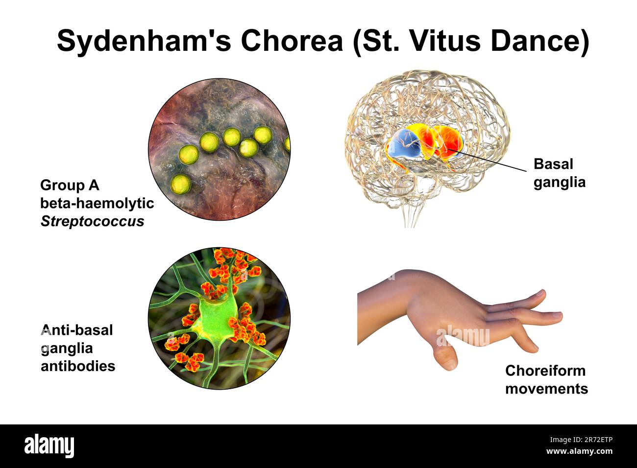 La chorée de Sydenham, une maladie auto-immune qui résulte de l ...