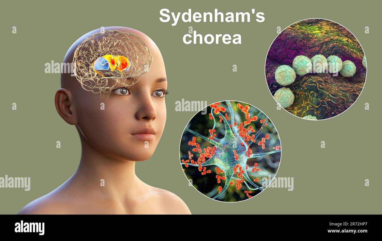 La chorée de Sydenham, une maladie auto-immune qui résulte de l ...