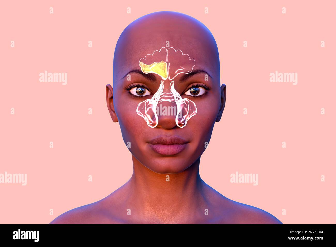 Infection sinusale, ou sinusite, illustration informatique. Les sinus ...