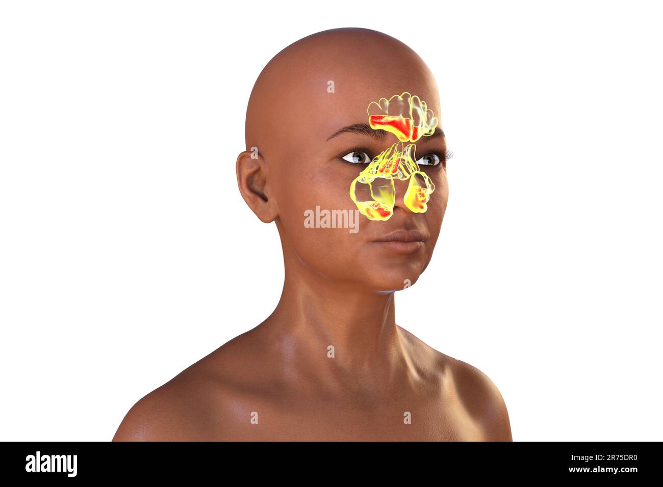 Infection sinusale, ou sinusite, illustration informatique. Les sinus ...