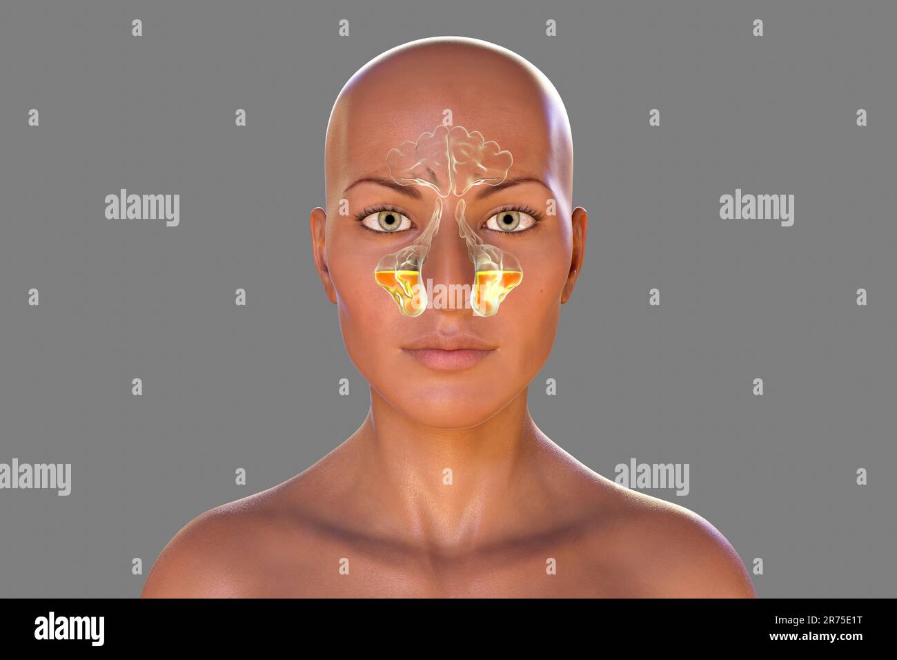 Infection sinusale, ou sinusite, illustration informatique. Les sinus ...