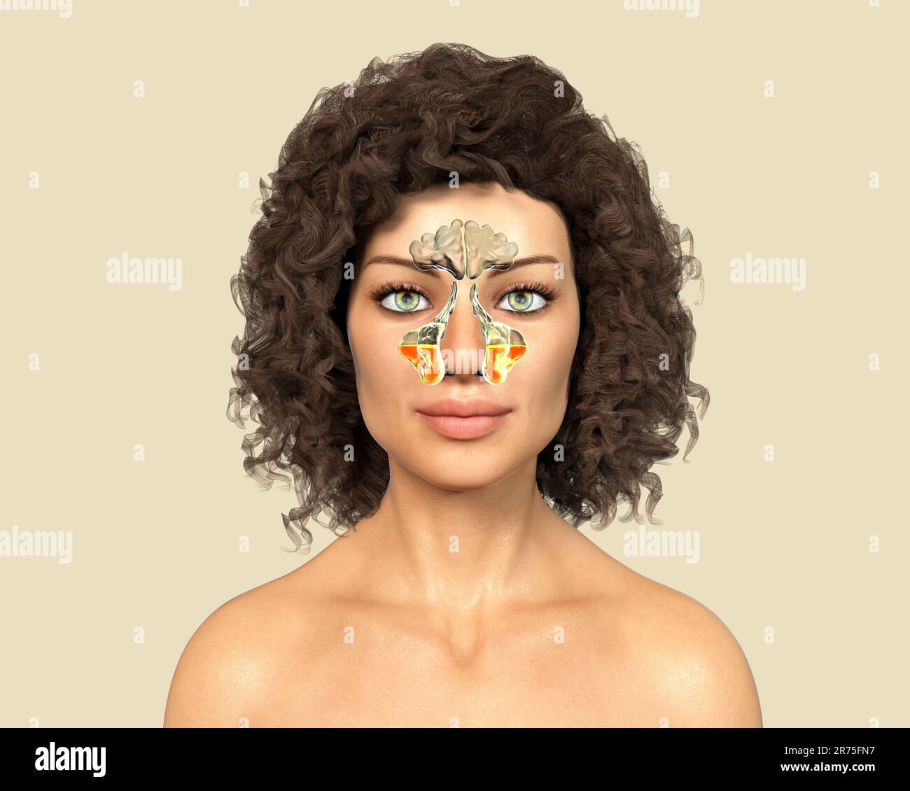 Infection sinusale, ou sinusite, illustration informatique. Les sinus ...