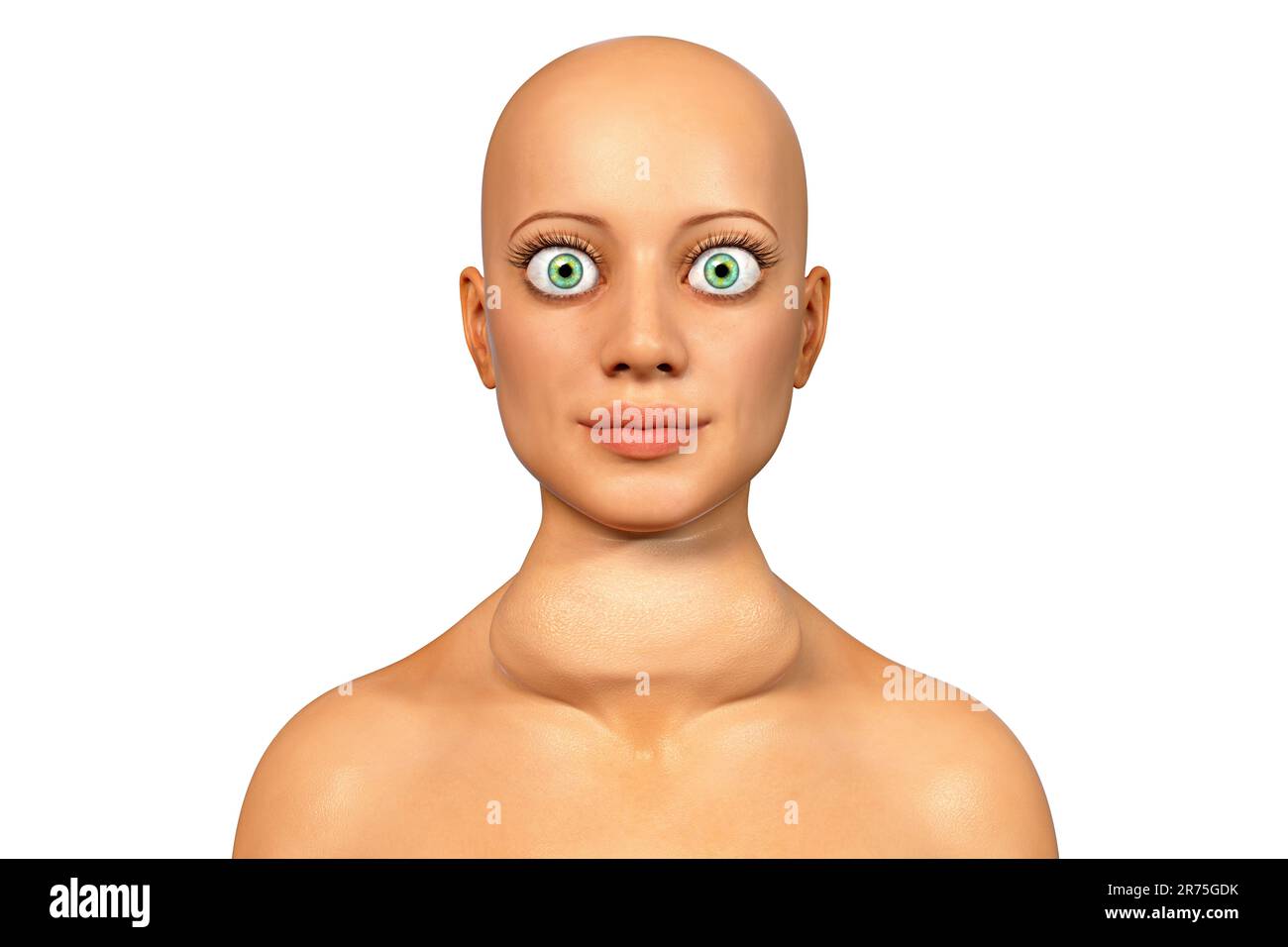 Goitre thyrotoxique (goitre), illustration. Goitre (cou gonflé) vu sur ...