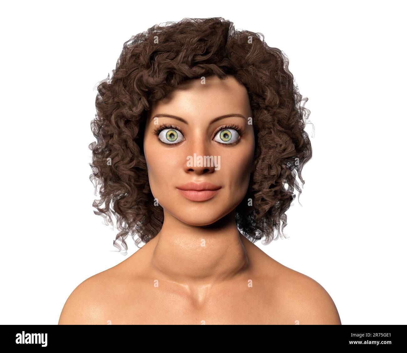 Enlarged goitre Banque de photographies et d’images à haute résolution ...