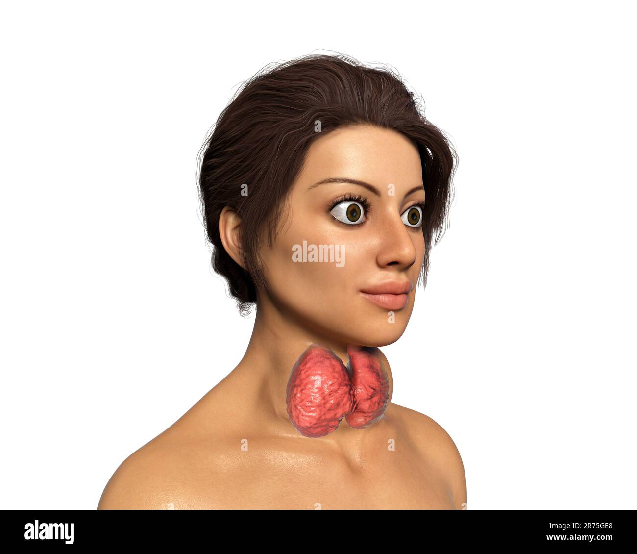 Enlarged goitre Banque de photographies et d’images à haute résolution ...