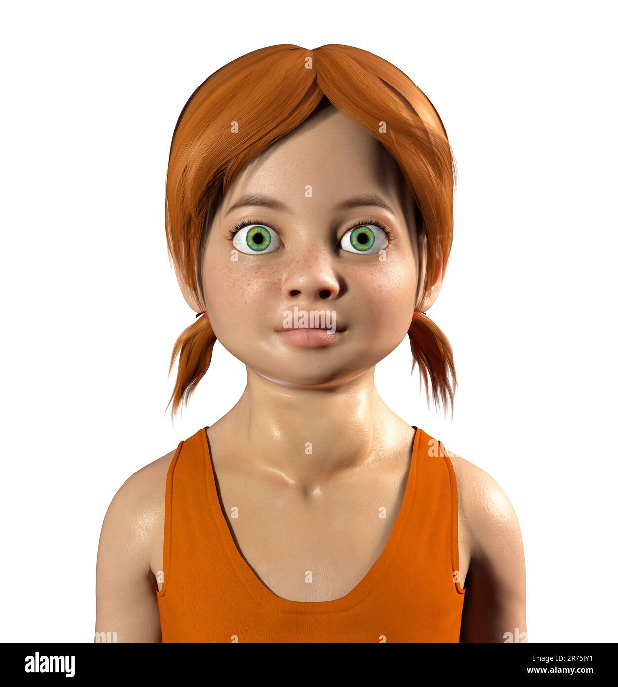 Goitre thyrotoxique (goitre), illustration. Goitre (cou gonflé) vu sur ...