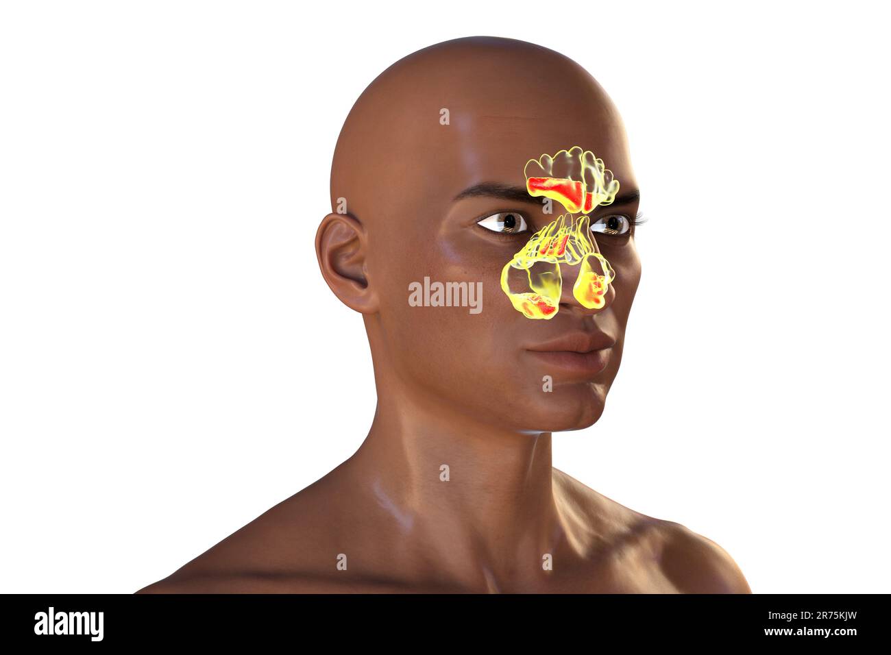 Sinusite, illustration informatique. Les sinus sont des espaces remplis ...