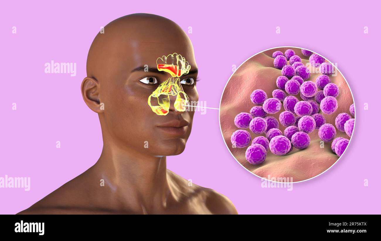 Sinusite bactérienne, illustration informatique. Les sinus sont des ...