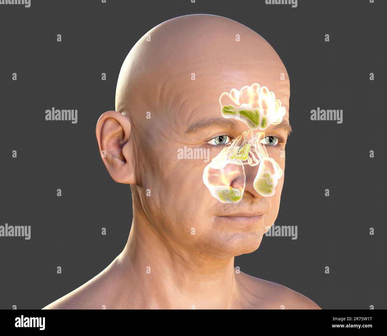 Infection sinusale, ou sinusite, illustration informatique. Les sinus ...