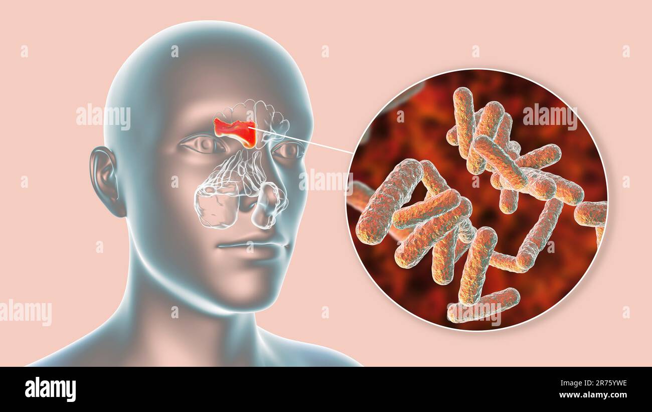 Sinusite bactérienne, illustration informatique. Les sinus sont des ...