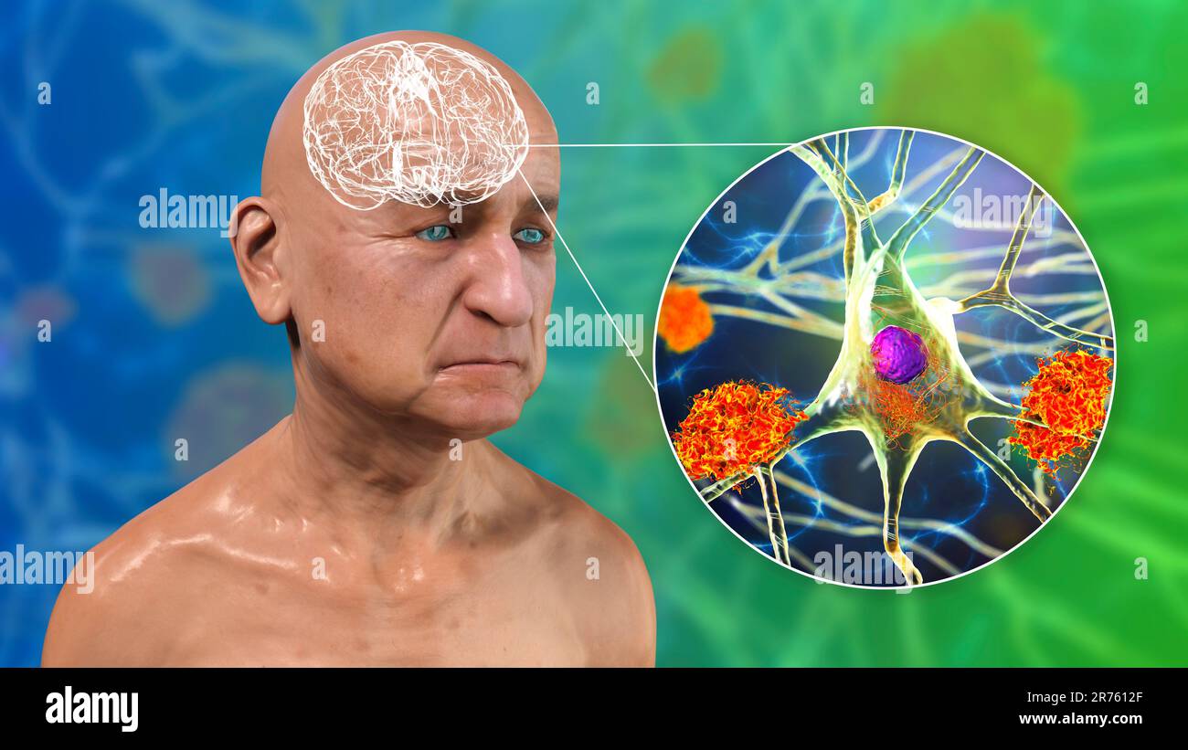 La maladie d'Alzheimer, illustration informatique conceptuelle montrant ...