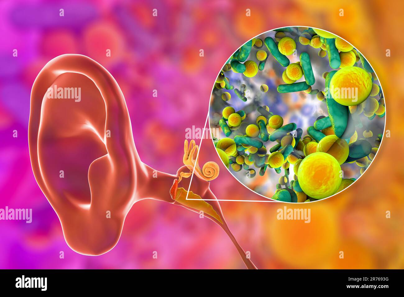 Otite moyenne aiguë Banque de photographies et d’images à haute ...