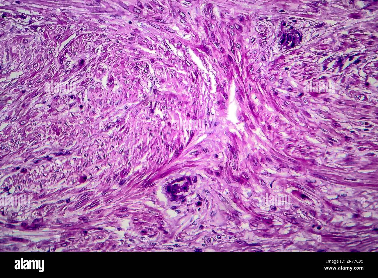 Les fibromes utérins. La lumière microphotographie (LM) d'une section à ...