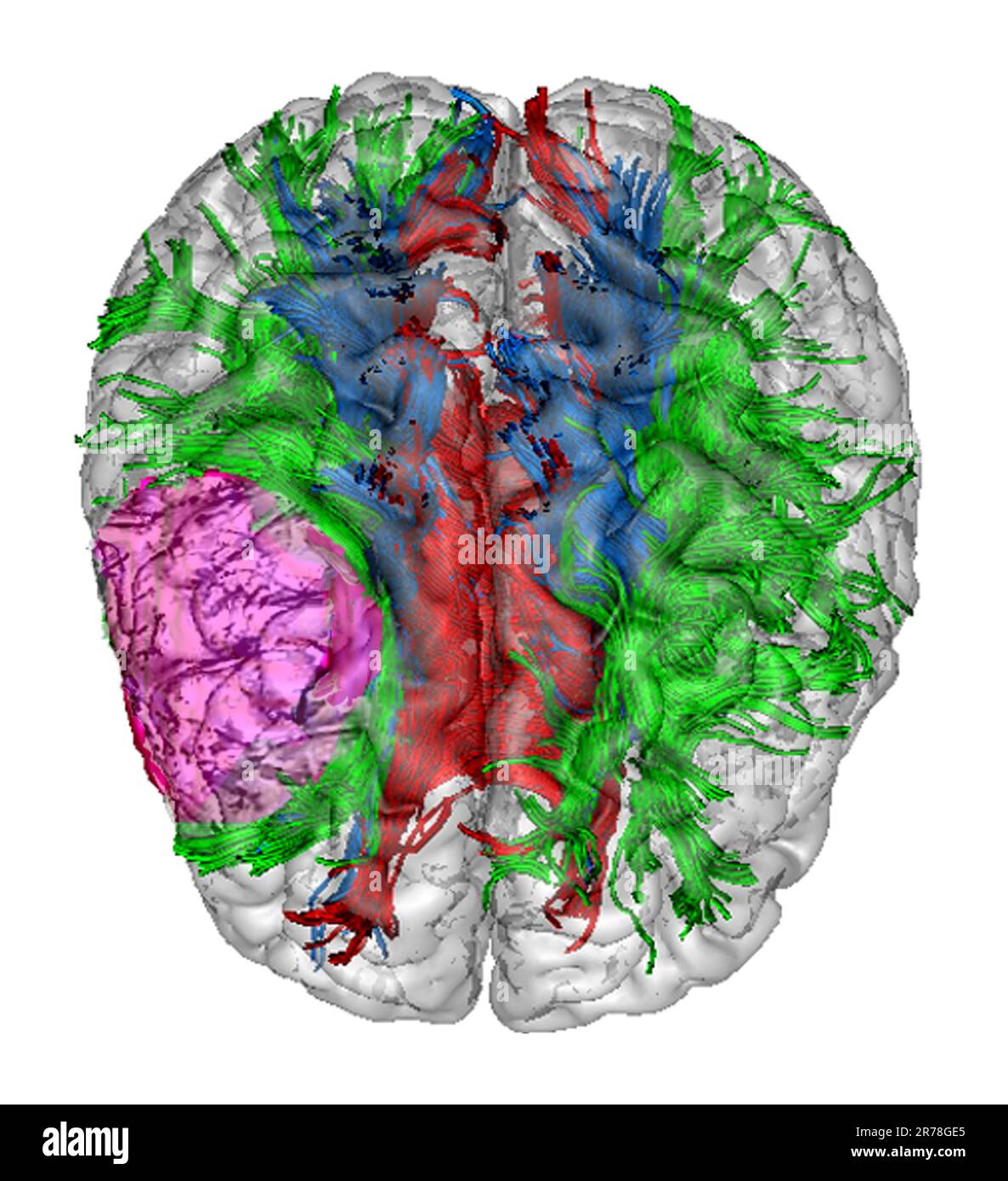 Imagerie par résonance magnétique (IRM) colorée à 3D tenseurs de diffusion (DTI) dans le cerveau ...