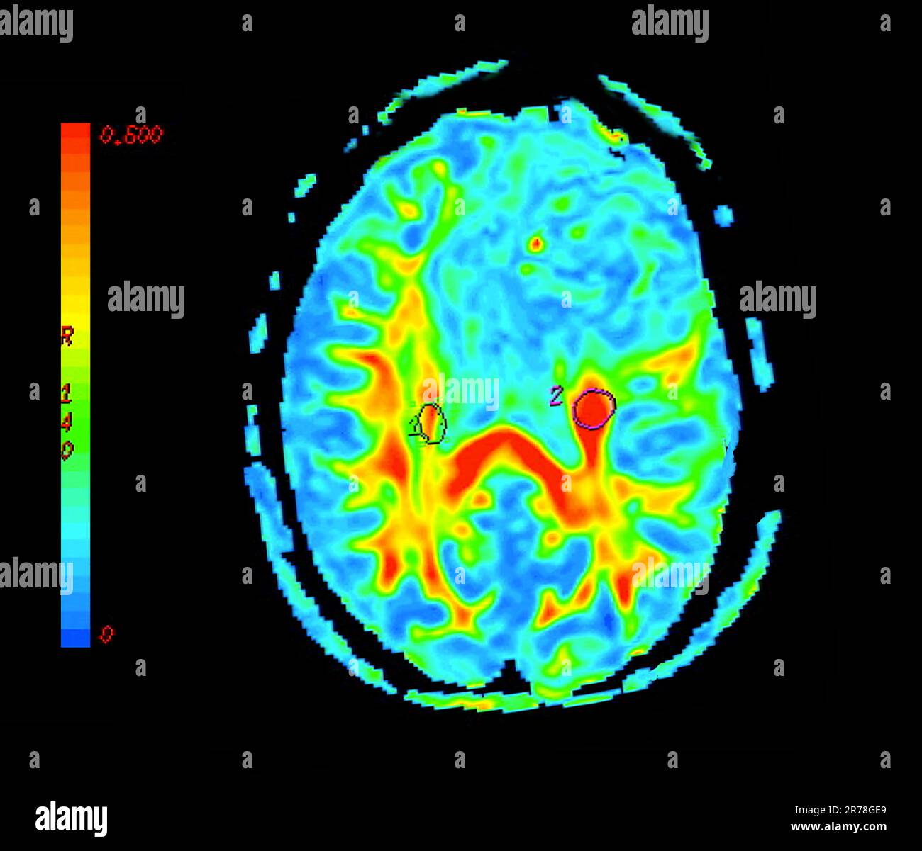 Imagerie par résonance magnétique à diffusion colorée (IRM) du cerveau d'un homme de 44 ans ...