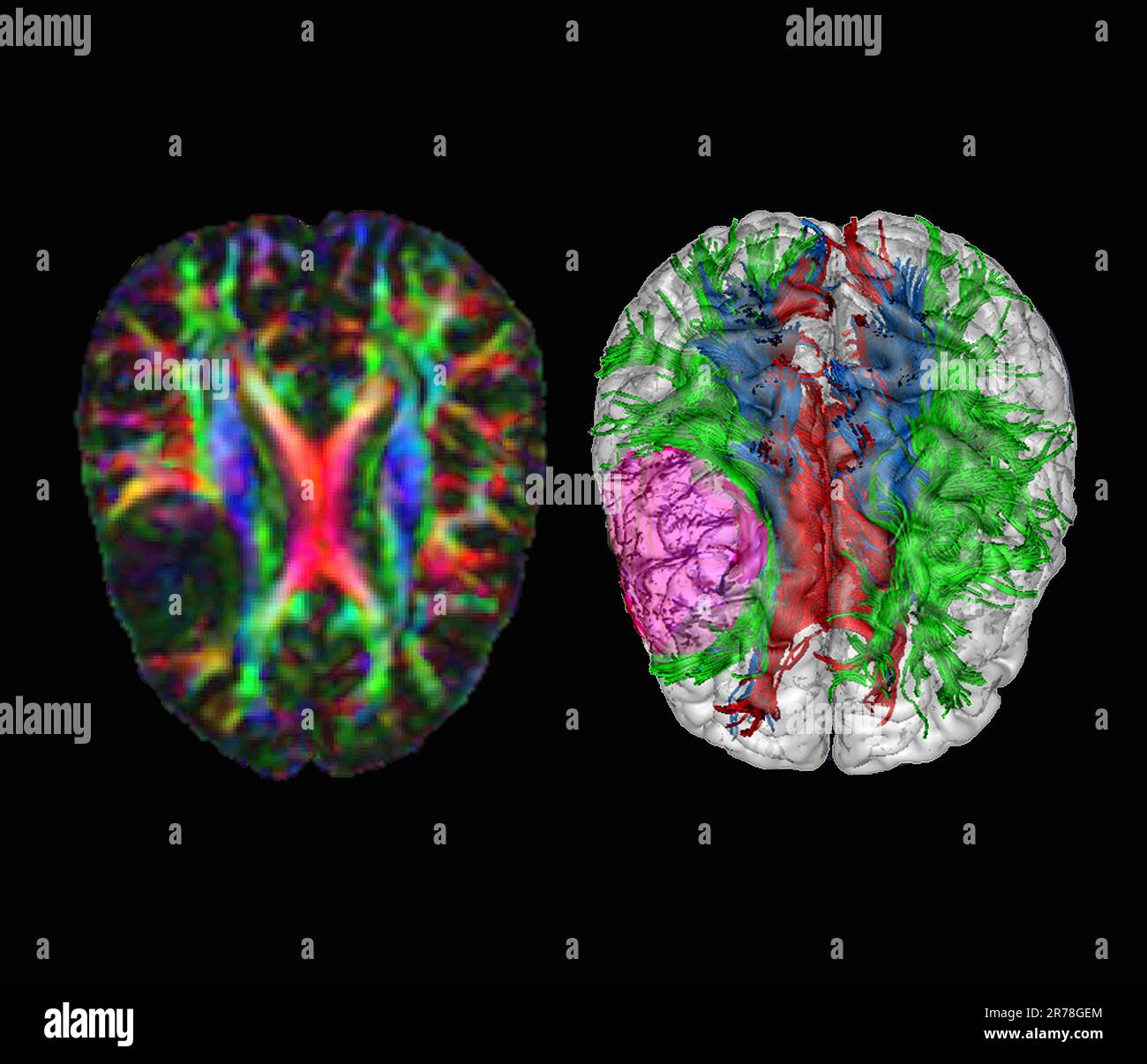 Imagerie par résonance magnétique (IRM) colorée 2D (gauche) et 3D (droite) du tenseur de ...