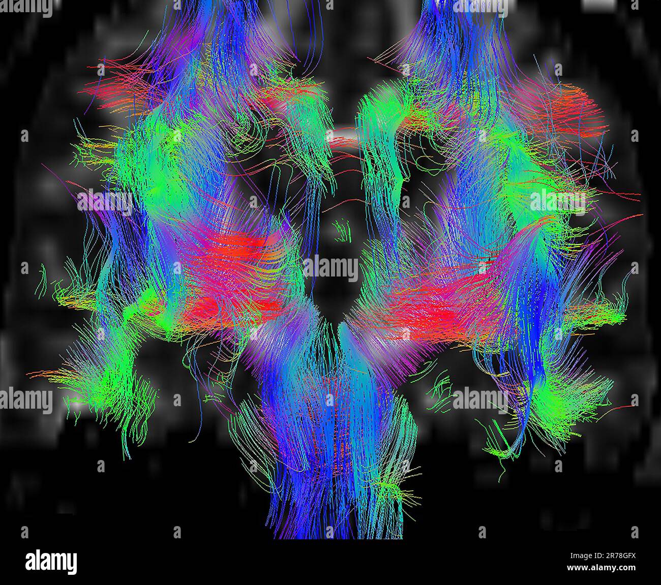Imagerie par résonance magnétique (IRM) à 3D tenseurs de diffusion ...