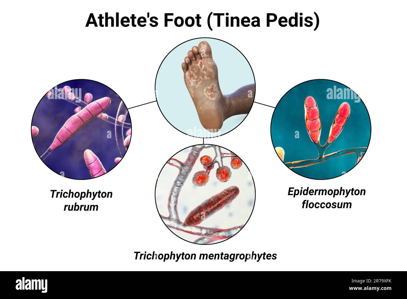 Le pied d'une personne à peau foncée avec mycose, et vue rapprochée des ...