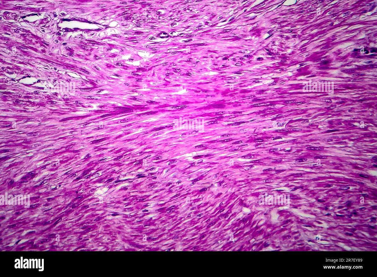 Les fibromes utérins. La lumière microphotographie (LM) d'une section à ...