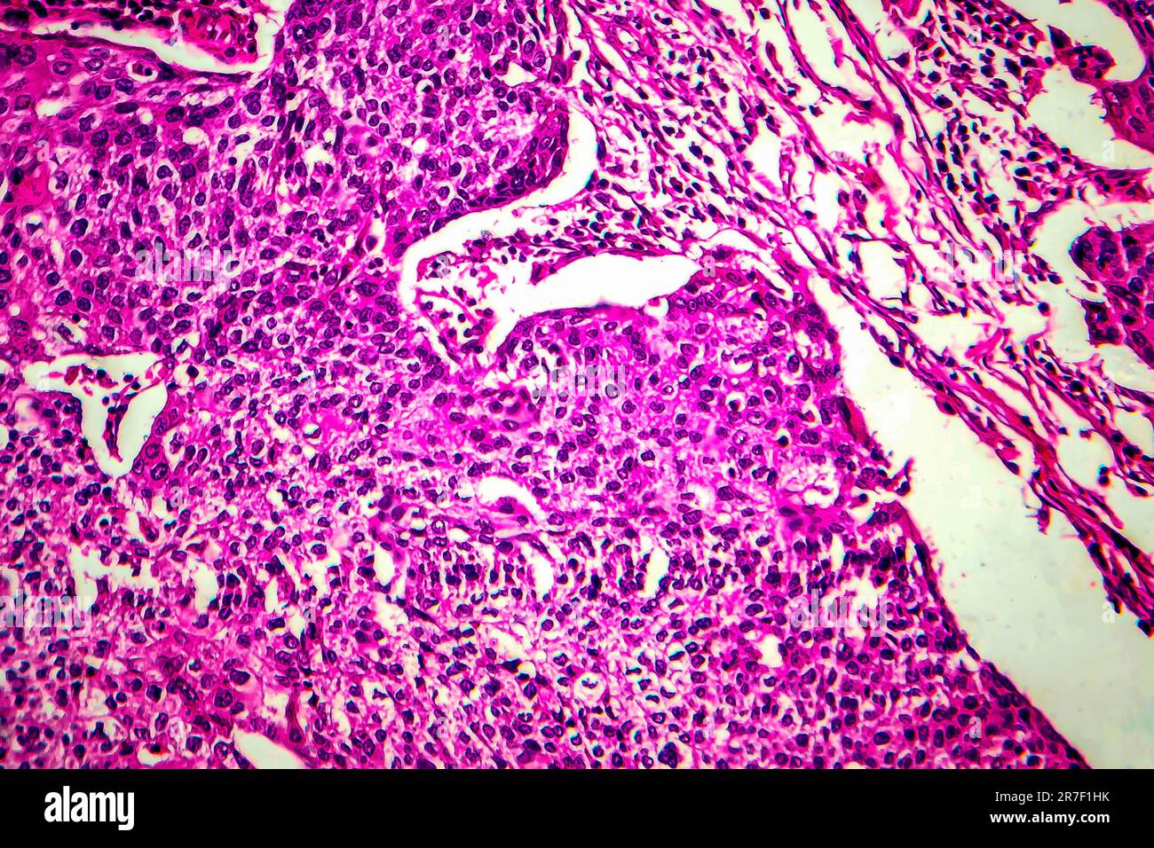 Cancer du col de l'utérus. La lumière microphotographie (LM) d'une section par l'intermédiaire d ...