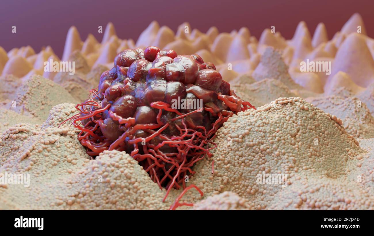 Croissance des cellules cancéreuses incontrôlable sur les tissus, les ...