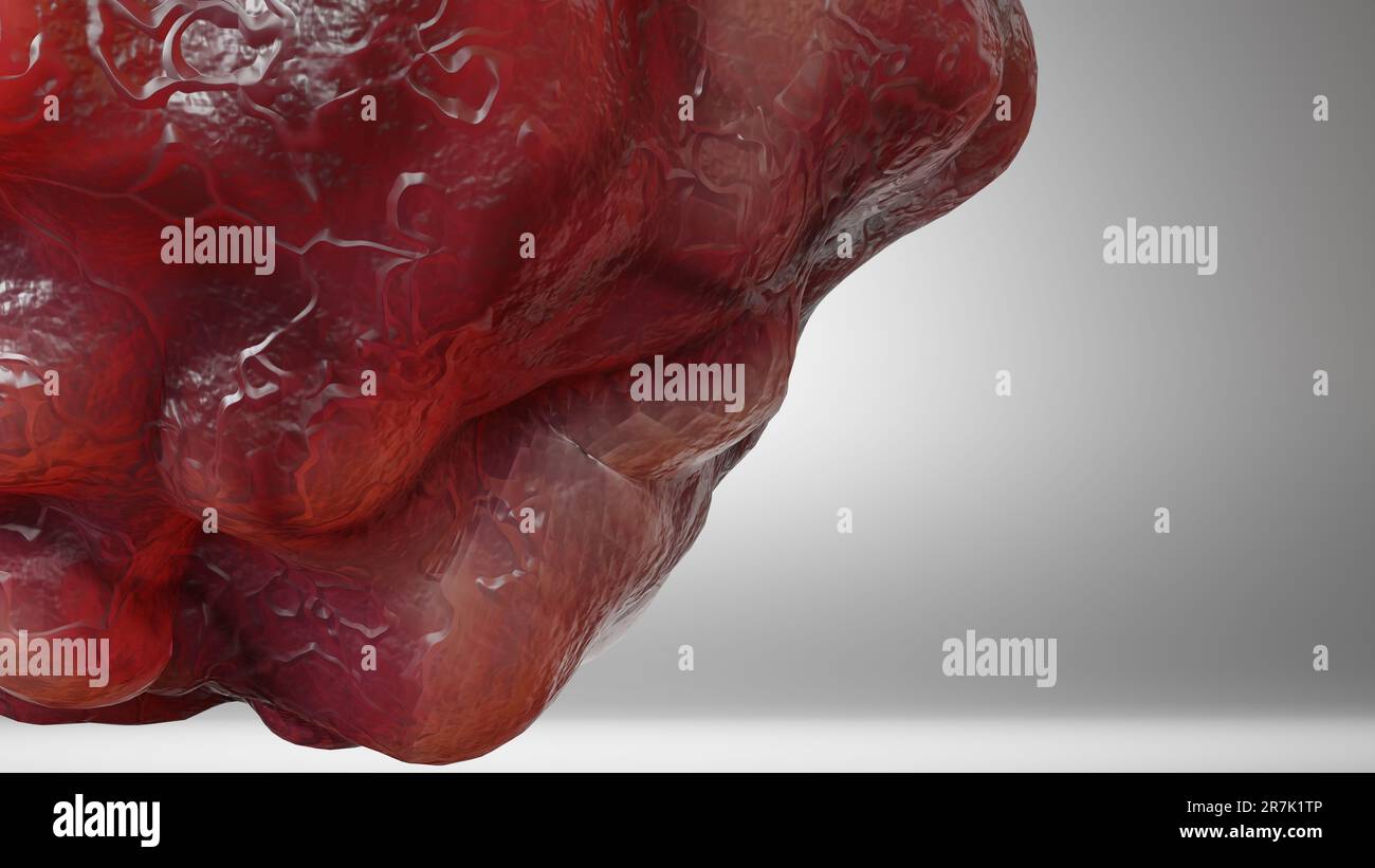 Croissance des cellules cancéreuses incontrôlable sur les tissus, les ...