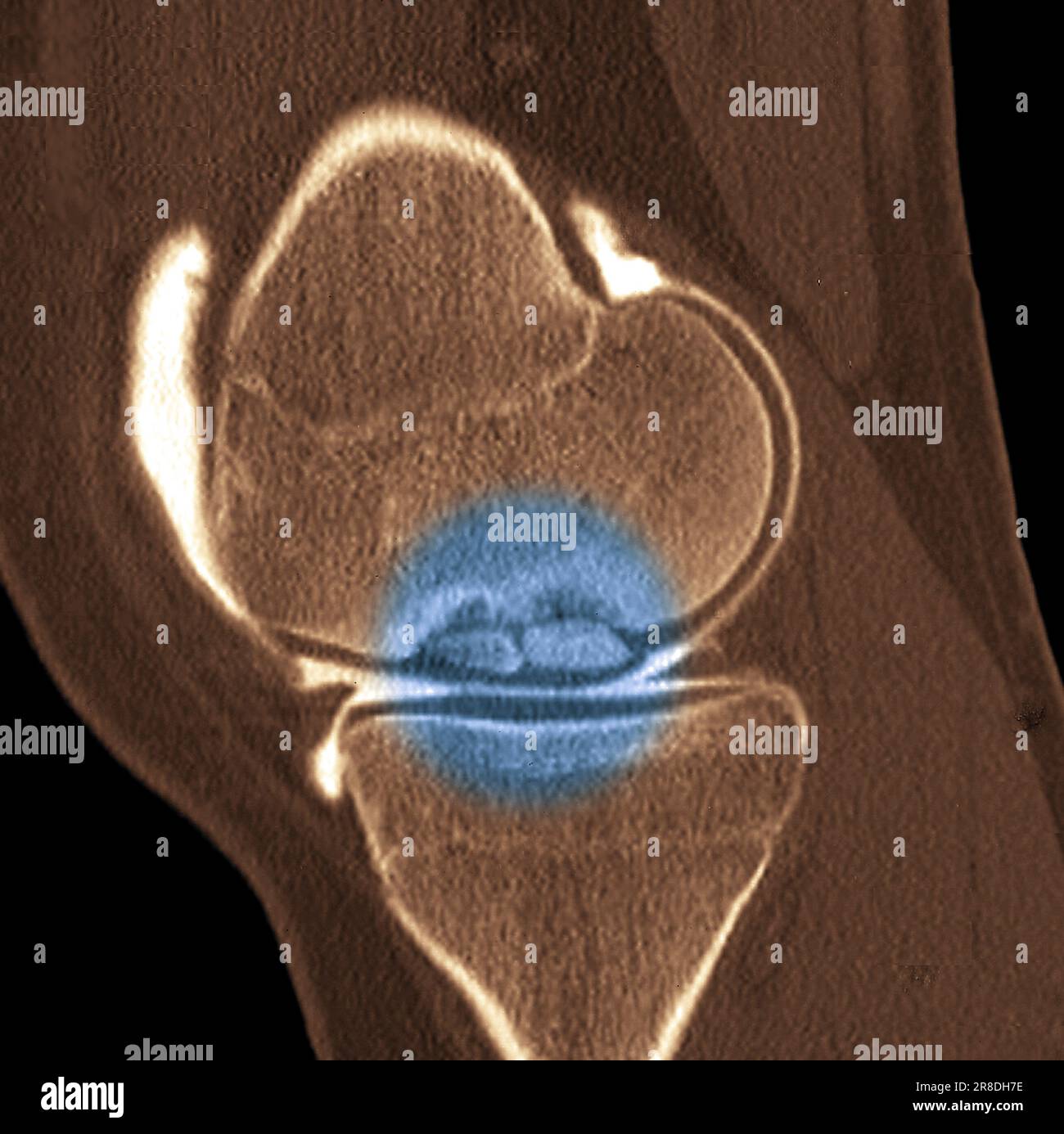 Scanner couleur 3D de tomographie par ordinateur (CT) du genou droit d ...