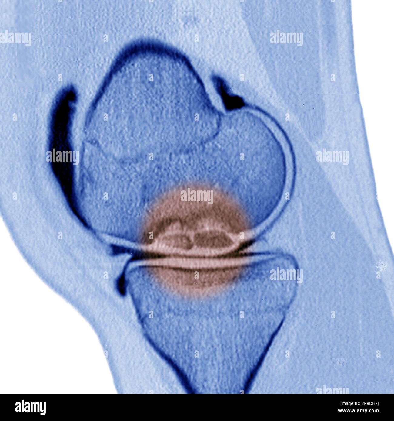 Scanner couleur 3D de tomographie par ordinateur (CT) du genou droit d ...