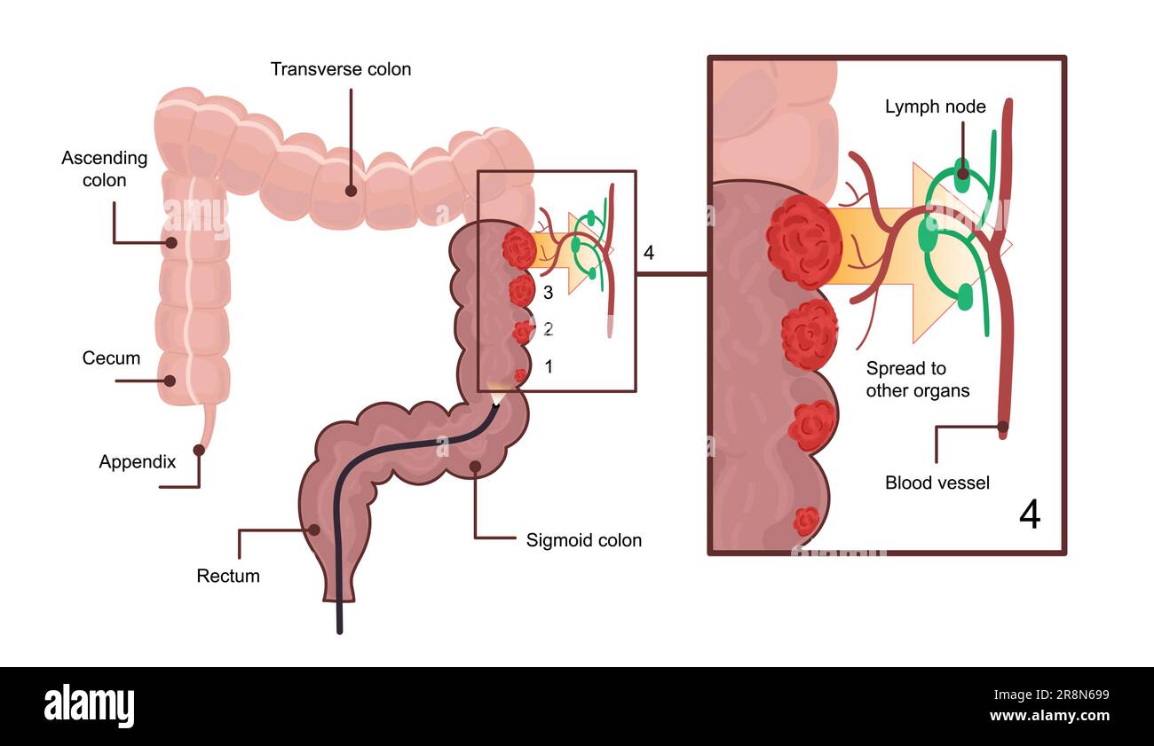 Schéma médical du cancer du côlon. schéma, illustration anatomique avec ...