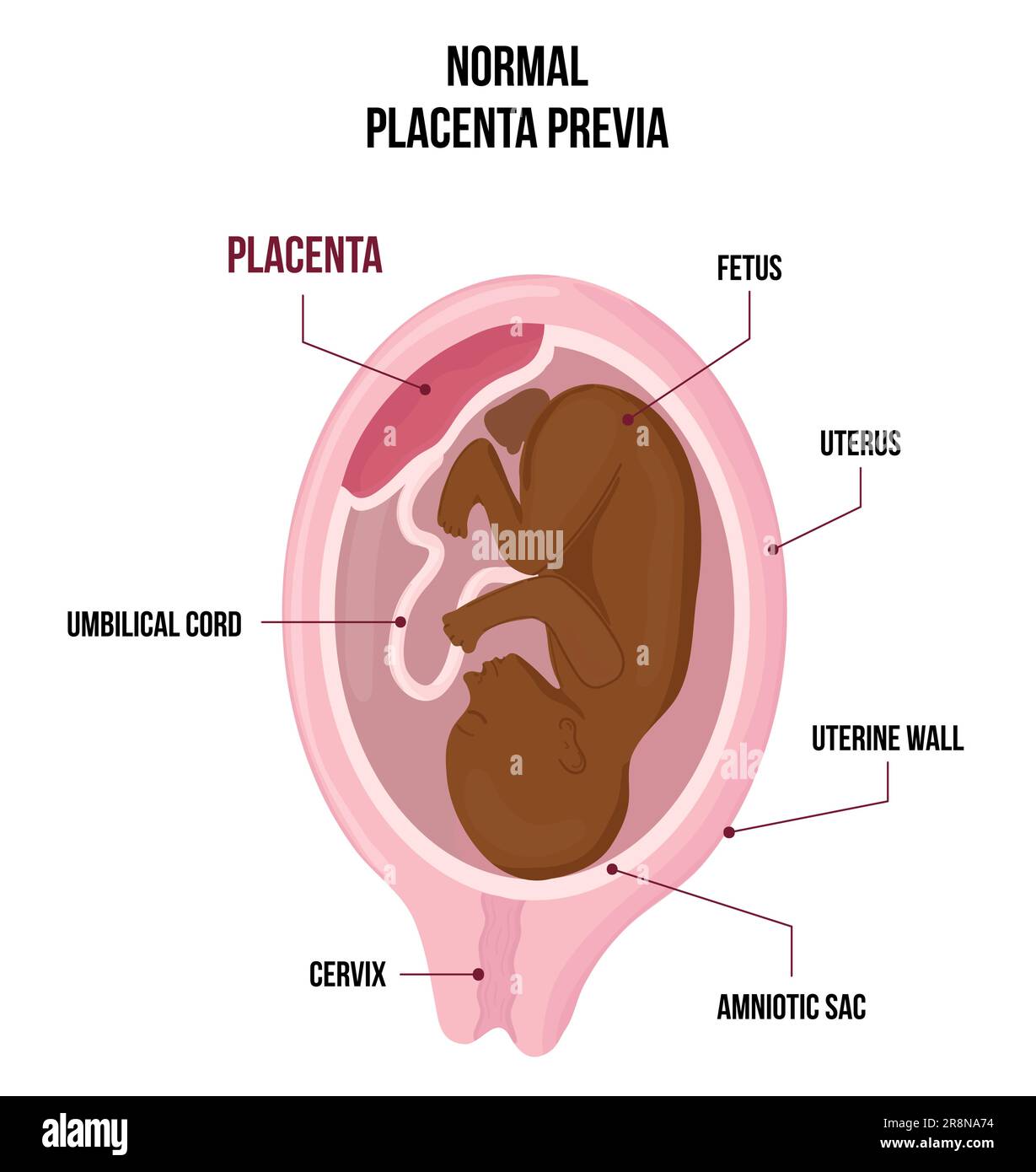 bébé à peau noire. Previa placentaire normal. Placenta anatomique ...
