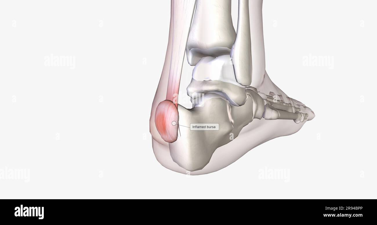 La déformation de Haglunds est un agrandissement osseux à l'arrière du talon, conduisant à une ...