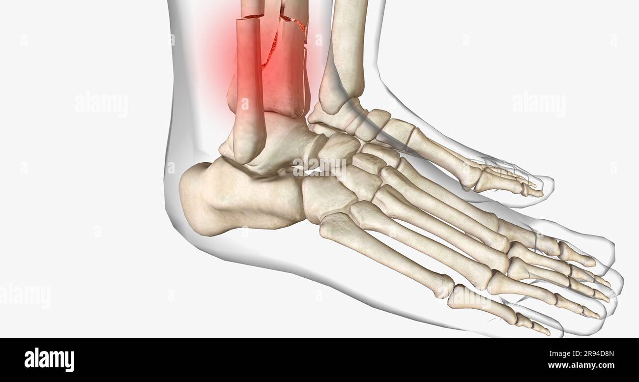 Les fractures du tibia distal affectent l'articulation de la cheville ...