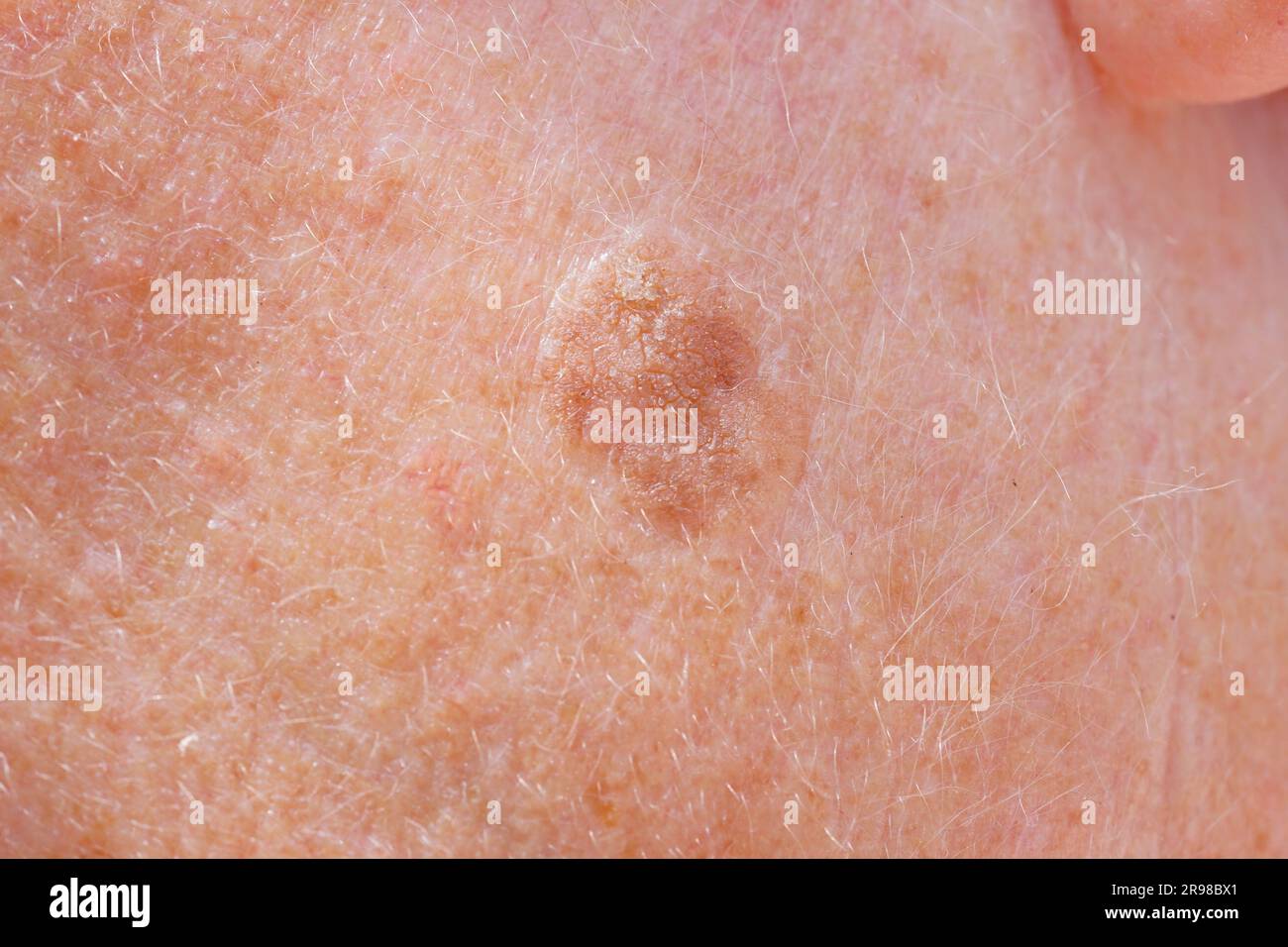 Mélanome cancer de la peau Banque de photographies et d’images à haute résolution - Alamy