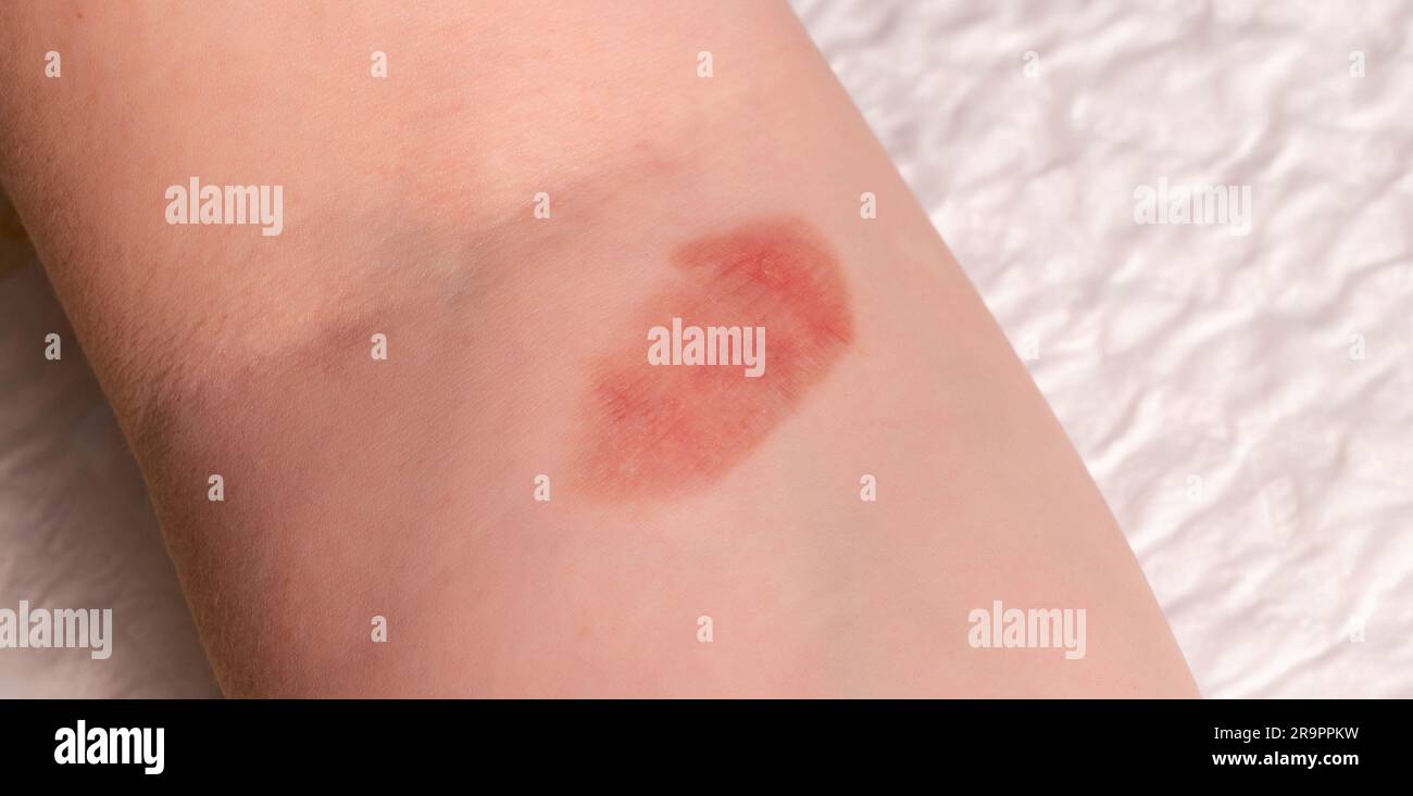 Tache rouge peau sur cicatrice Banque de photographies et d’images à ...