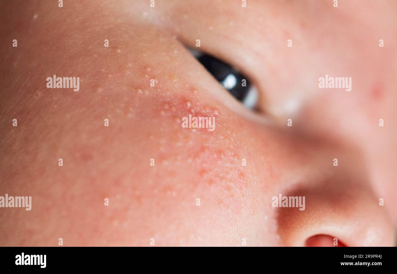 Éruption cutanée sur le visage d'un nouveau-né. Le processus de ...
