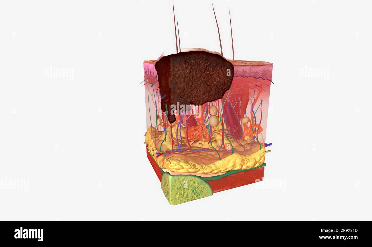 Les tumeurs de mélanome de stade I se sont répandues de l'épiderme et dans le rendu dermis 3D ...
