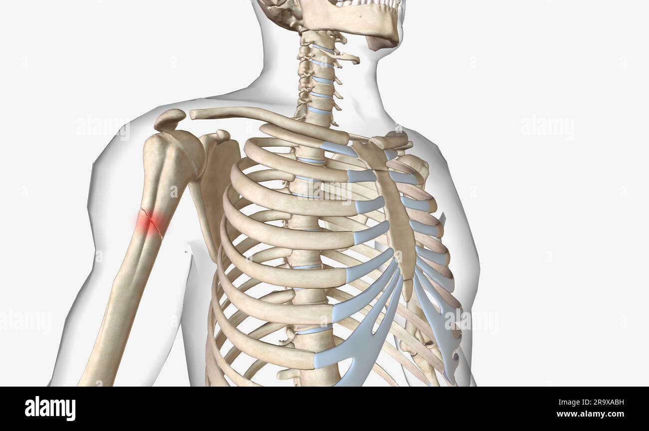 Une fracture, appelée rupture d'os , est une blessure aiguë qui ...