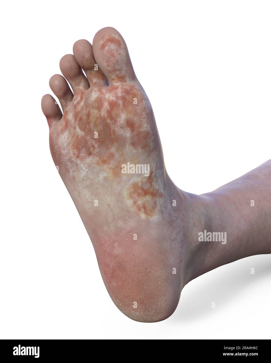 Infection des pieds Banque de photographies et d’images à haute ...