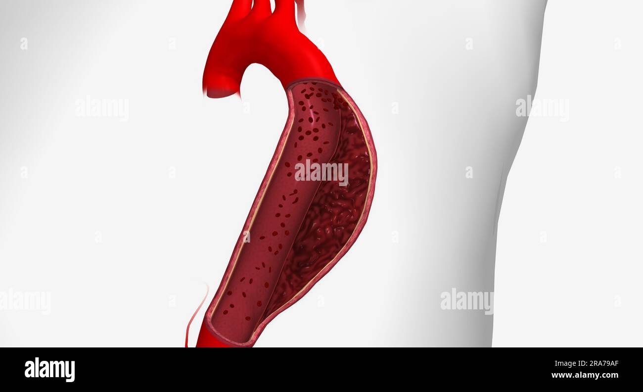 La dissection aortique est une maladie cardiovasculaire grave ...