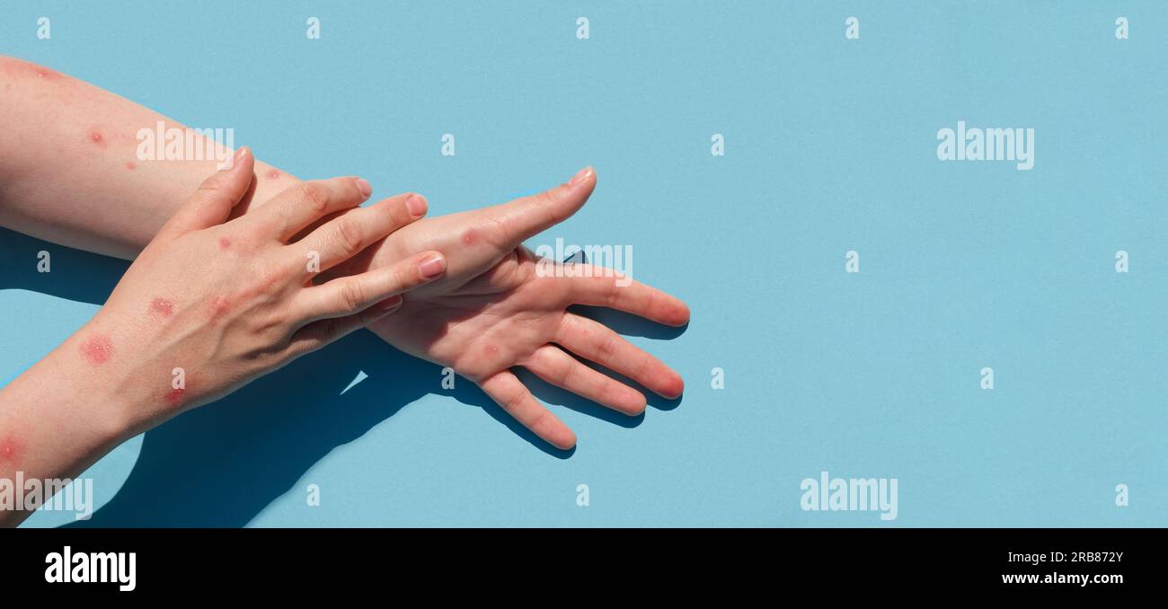 éruption cutanée sur les mains Banque de photographies et d’images à ...