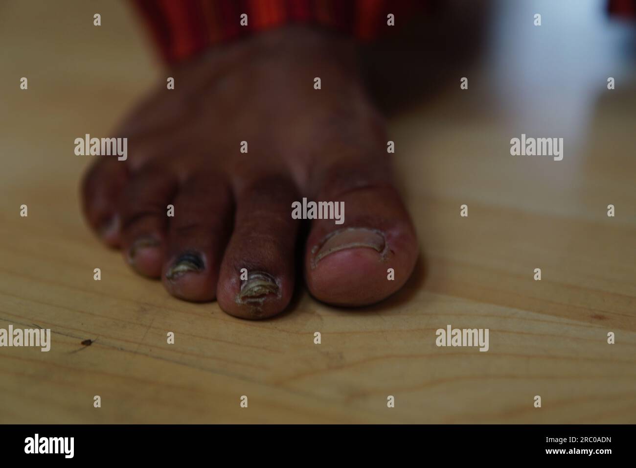 Pieds infectés mycose Banque de photographies et d’images à haute ...