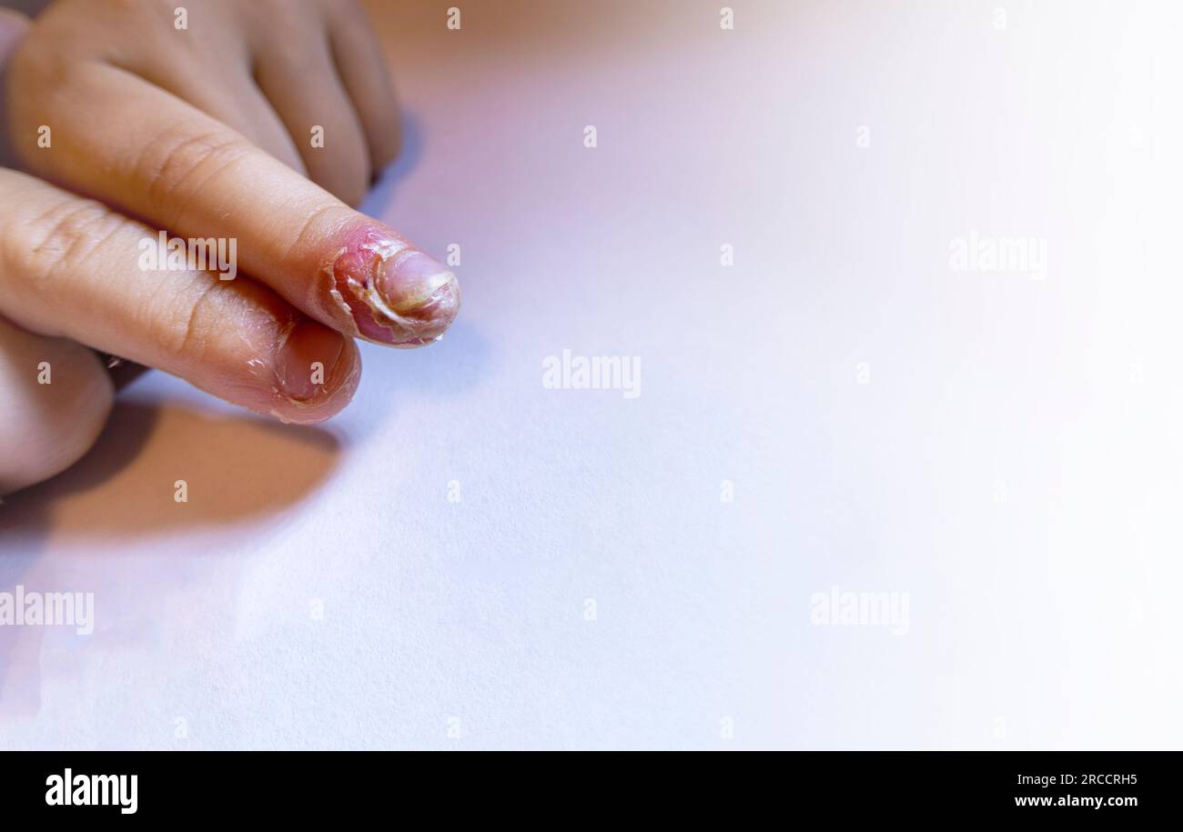 Maladie de la peau du a quoi Banque de photographies et d’images à ...