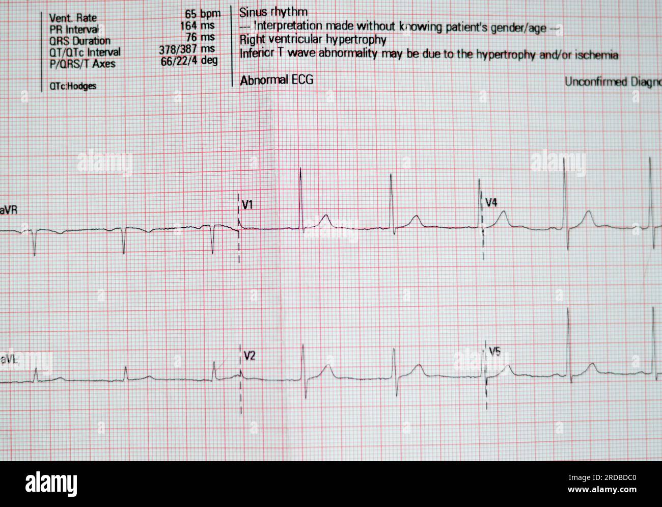 Papier électrocardiographique ECG montrant une anomalie du rythme sinusal d'hypertrophie ...