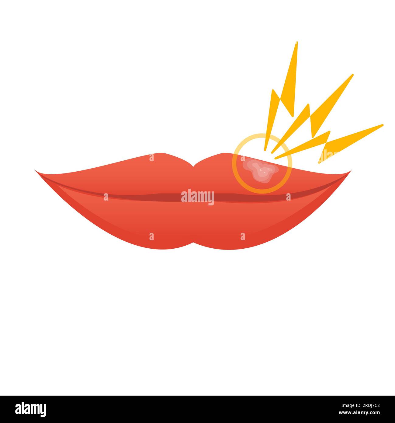 Herpes simplex lesions Banque d'images détourées - Alamy